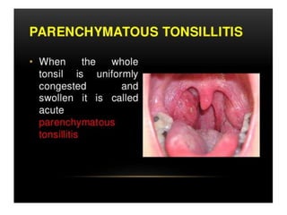 tonsillitis 1.ppt........................ | PPT