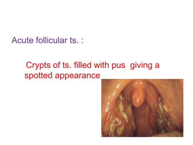 tonsillitis 1.ppt........................ | PPT