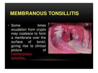 tonsillitis 1.ppt........................ | PPT