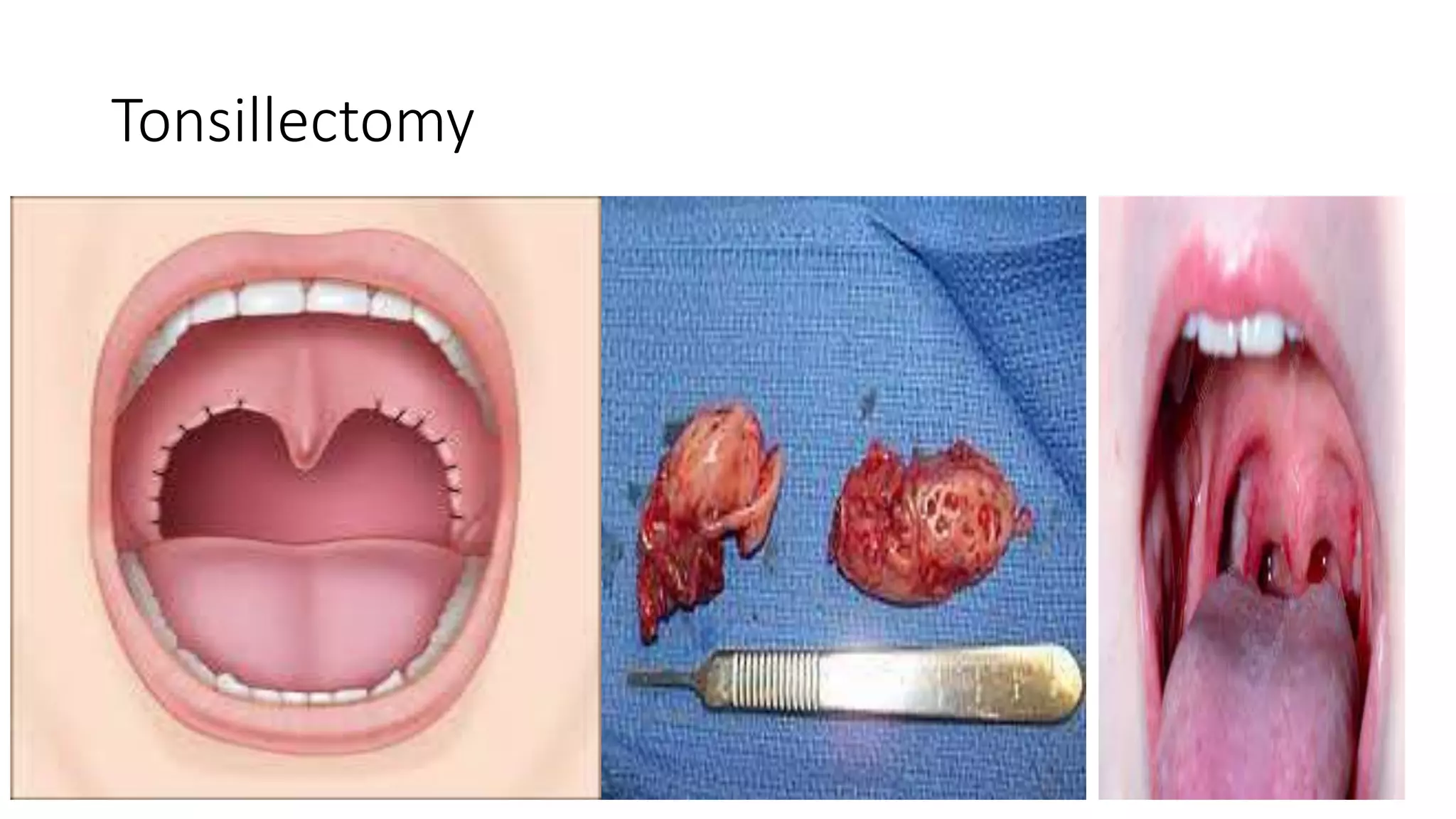 TONSILLITIS bay ram.pptx