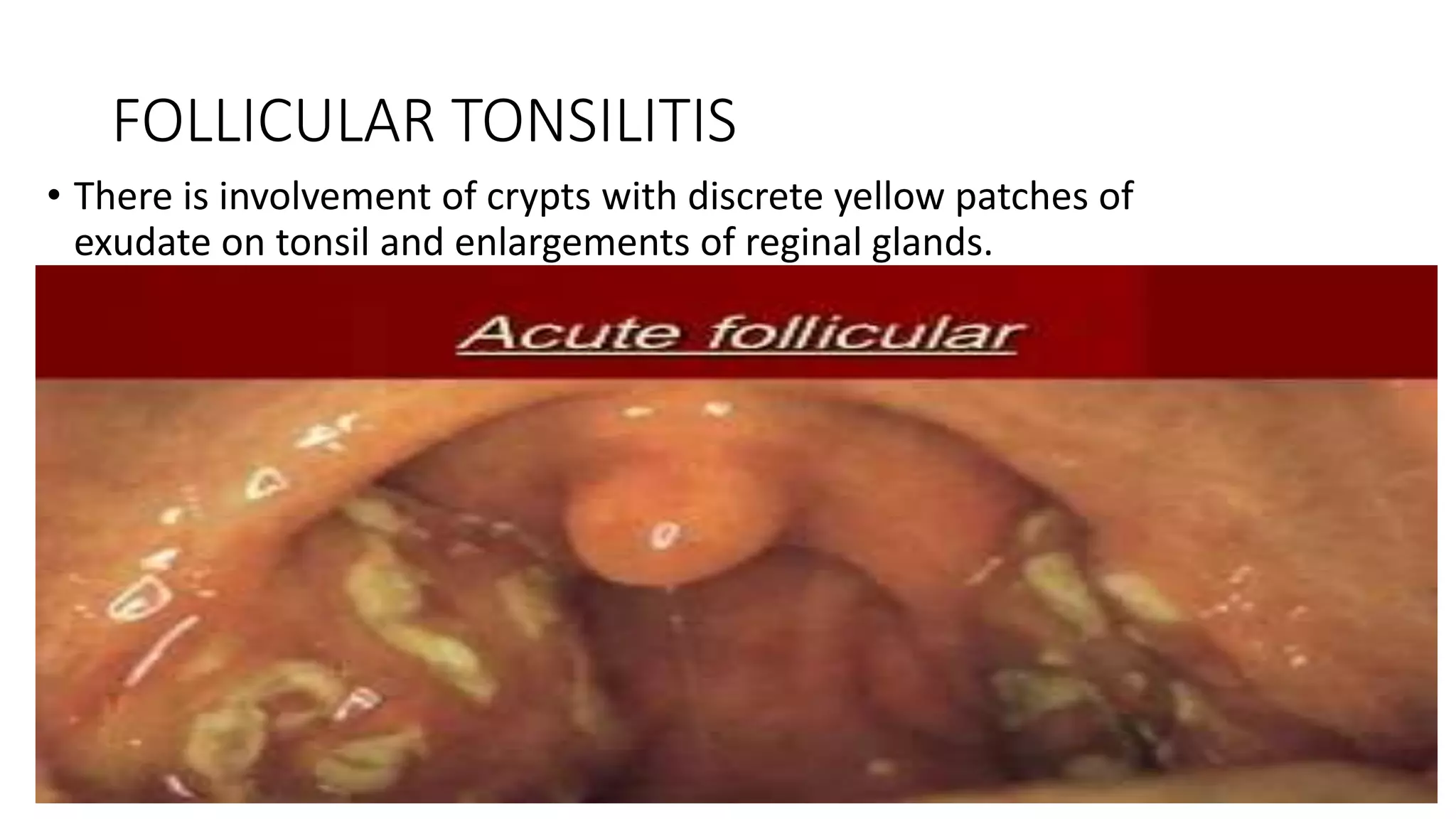 TONSILLITIS bay ram.pptx