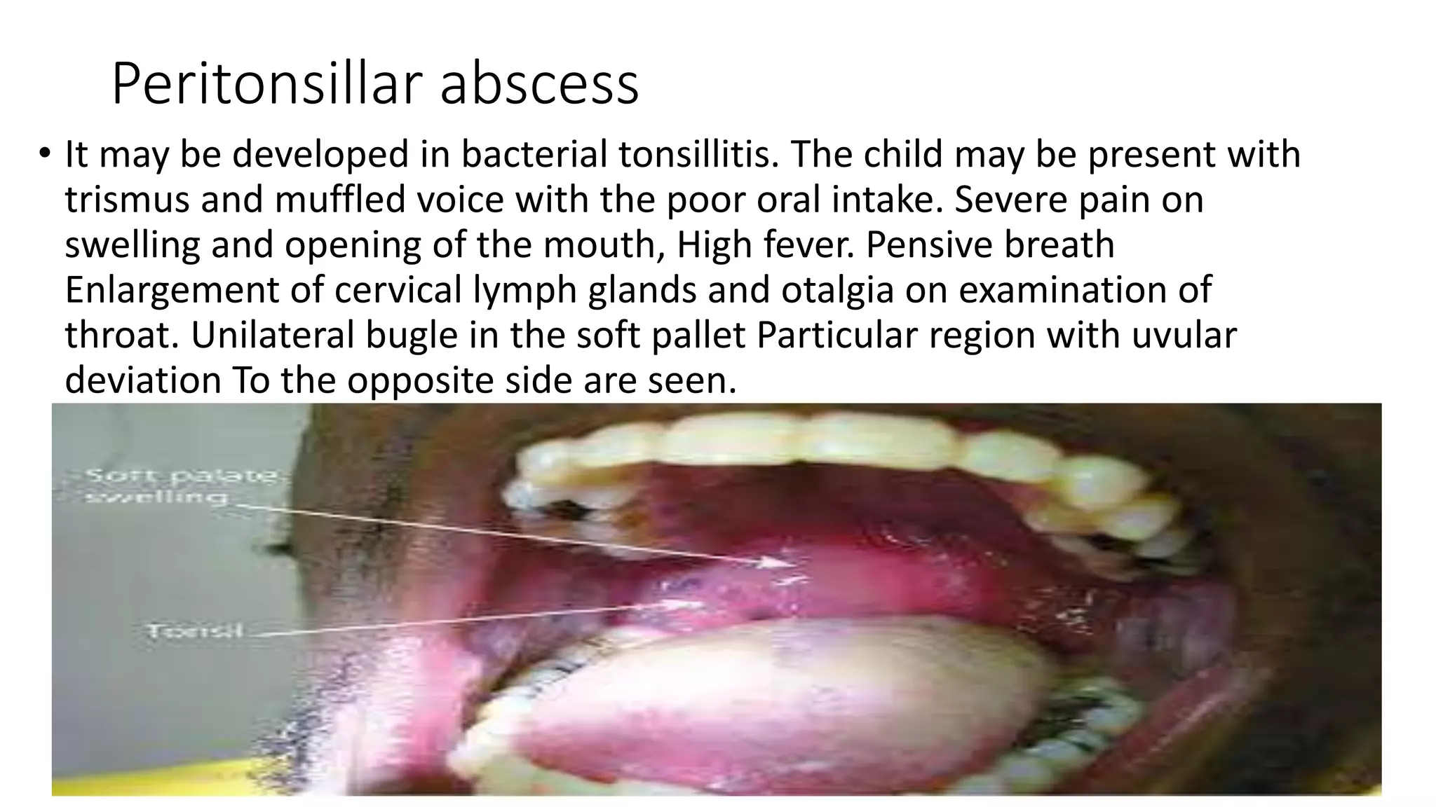TONSILLITIS bay ram.pptx