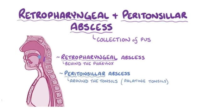 TONSILLITIS bay ram.pptx