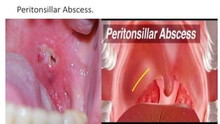 TONSILLITIS bay ram.pptx