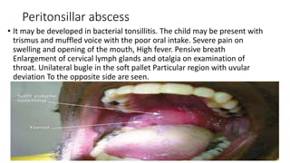 TONSILLITIS bay ram.pptx