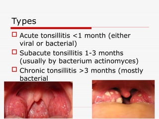 Tonsillitis by dr Adel Adwan ptt for all | PPT | Ear, Nose and Throat ...