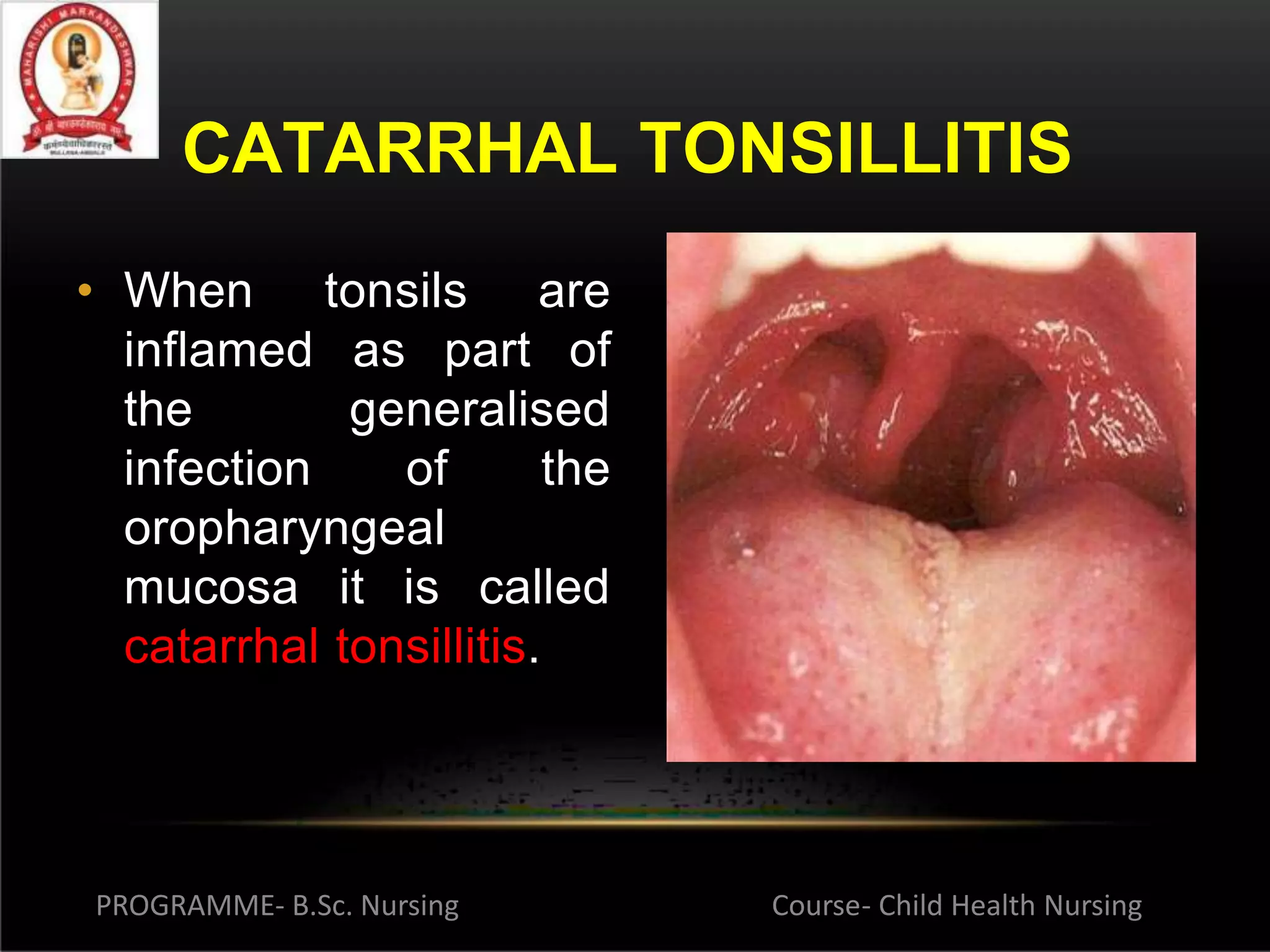 tonsillitis .pptx | Ear, Nose and Throat Conditions | Diseases and Conditions