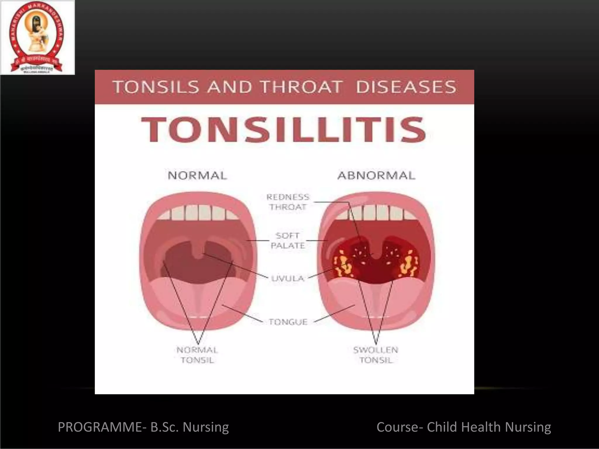 tonsillitis .pptx | Ear, Nose and Throat Conditions | Diseases and Conditions