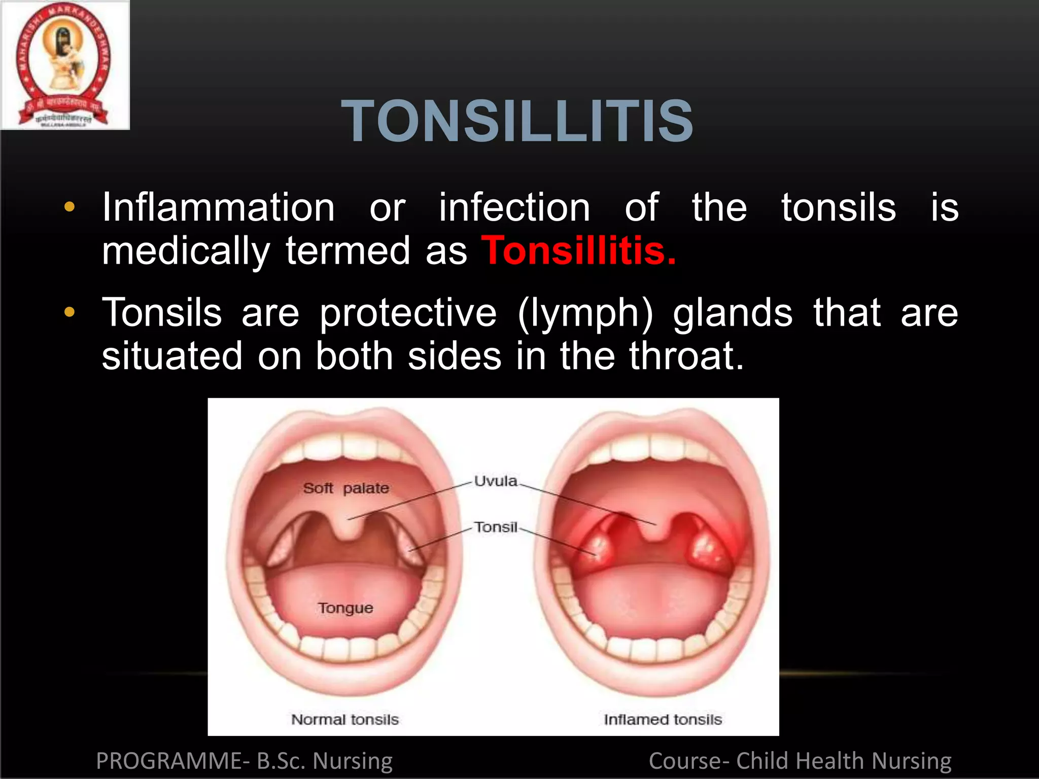 tonsillitis .pptx | Ear, Nose and Throat Conditions | Diseases and Conditions