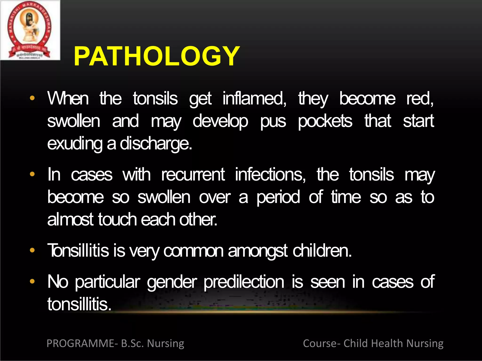 tonsillitis .pptx