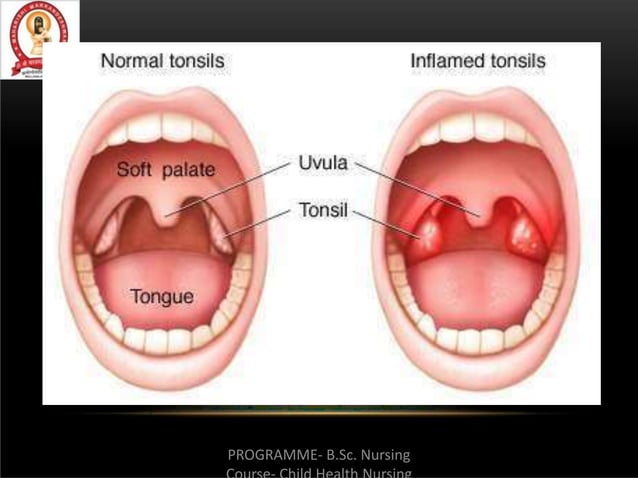 tonsillitis .pptx