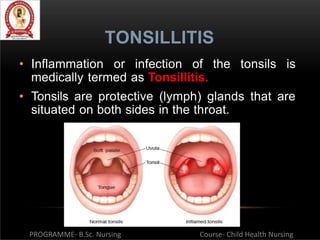 tonsillitis .pptx | Ear, Nose and Throat Conditions | Diseases and Conditions