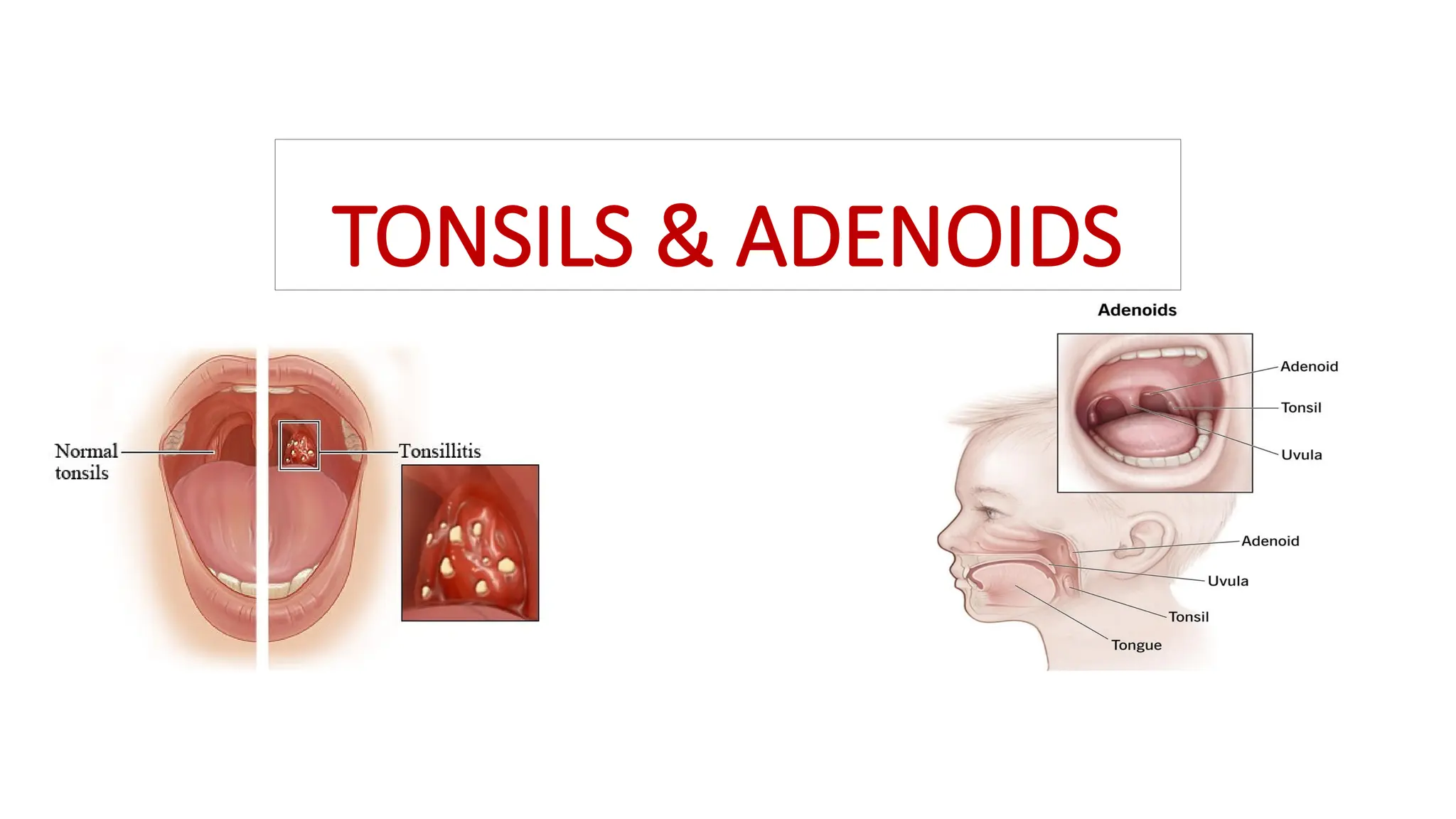 Tonsillitis new.pptx adenoids - ENT , adenoids hypertrophy and tonsillitis | PPT