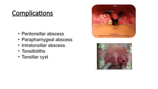 Tonsillitis new.pptx adenoids - ENT , adenoids hypertrophy and ...
