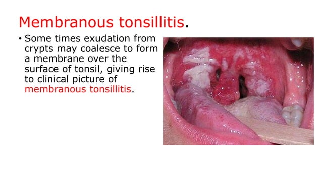 Tonsillitis, quinsy and adenoiditis | PPTX | Ear, Nose and Throat ...