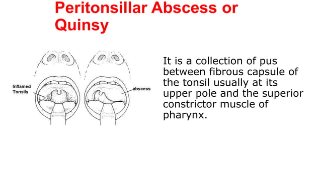 Tonsillitis, quinsy and adenoiditis | PPTX | Ear, Nose and Throat ...