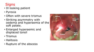 Tonsillitis, quinsy and adenoiditis | PPTX