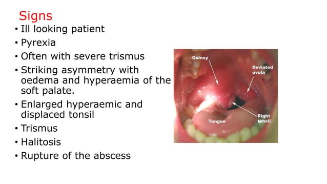 Tonsillitis, quinsy and adenoiditis | PPT