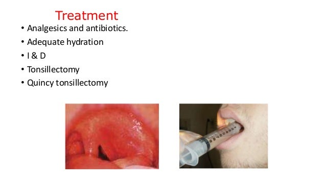 Tonsillitis, quinsy and adenoiditis