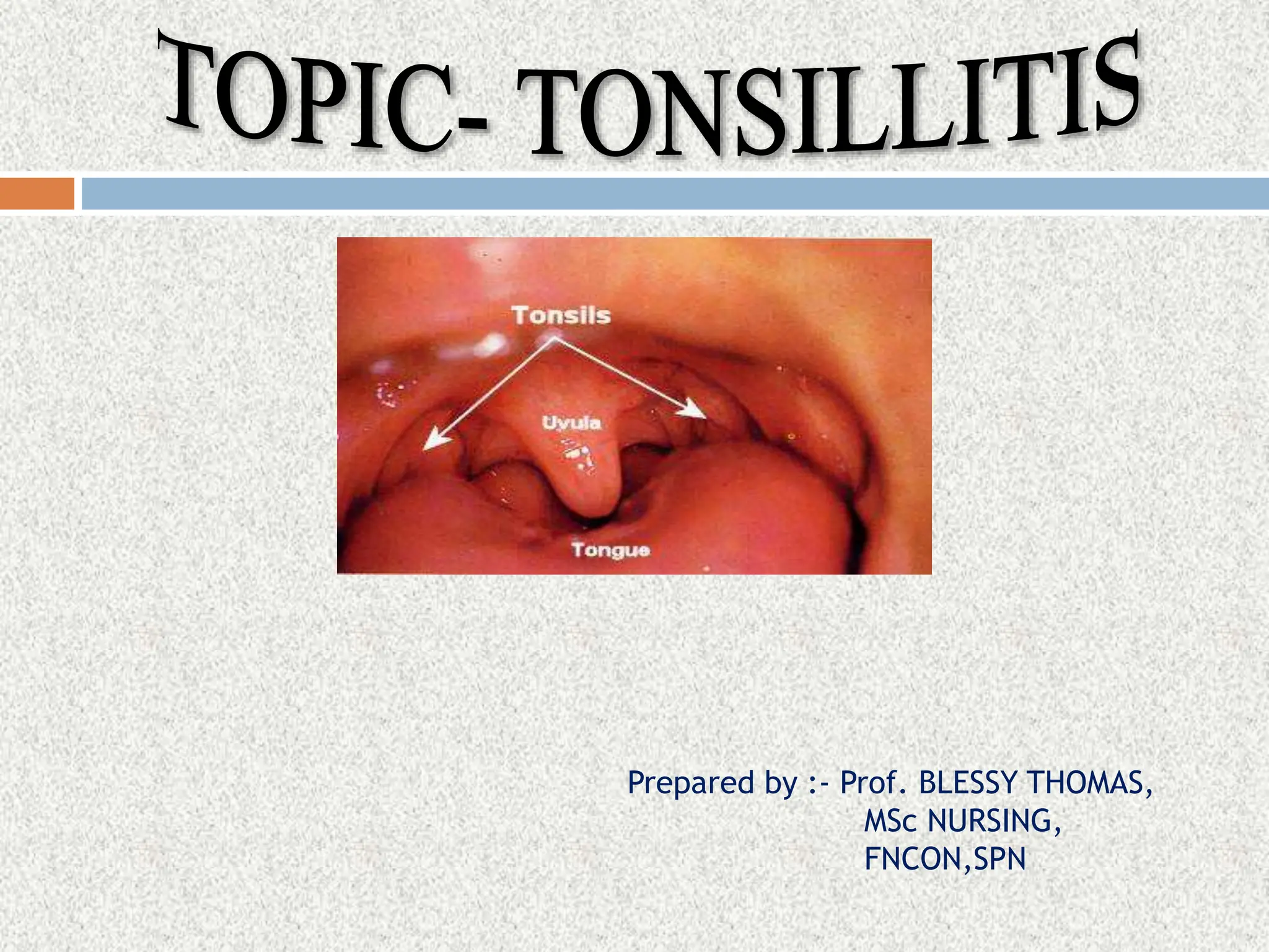 Nursing management of the patient with Tonsillitis PPT | PPTX