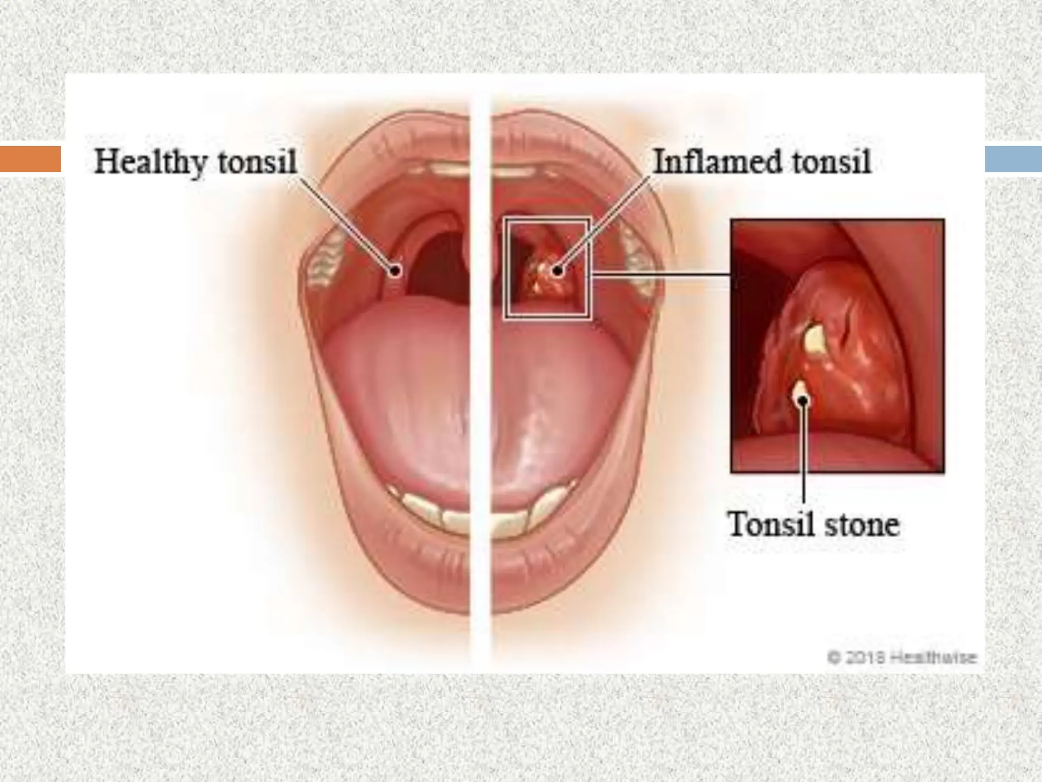 Nursing management of the patient with Tonsillitis PPT | PPTX