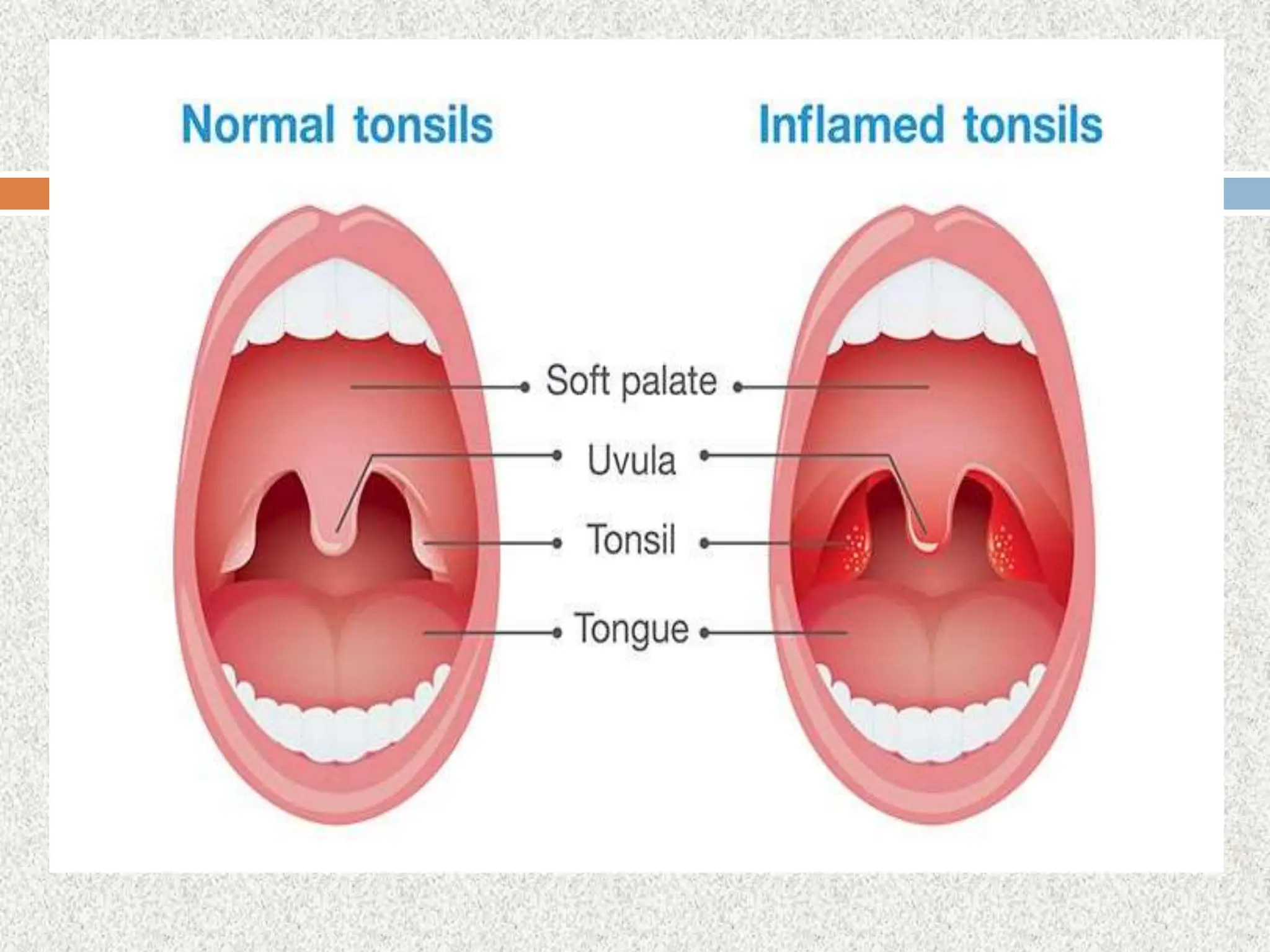 Nursing management of the patient with Tonsillitis PPT | PPTX