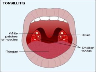 Nursing management of the patient with Tonsillitis PPT | PPTX
