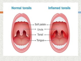 Nursing management of the patient with Tonsillitis PPT | PPTX