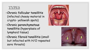 Tonsillitis | PPTX | Ear, Nose and Throat Conditions | Diseases and ...
