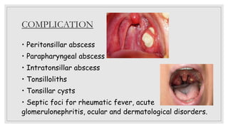 Tonsillitis | PPTX | Ear, Nose and Throat Conditions | Diseases and ...