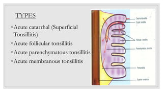 Tonsillitis | PPTX | Ear, Nose and Throat Conditions | Diseases and ...