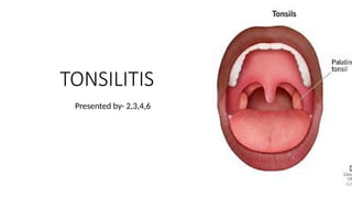 TONSIL infection of the tonsil it may be acute and chronic | PPTX
