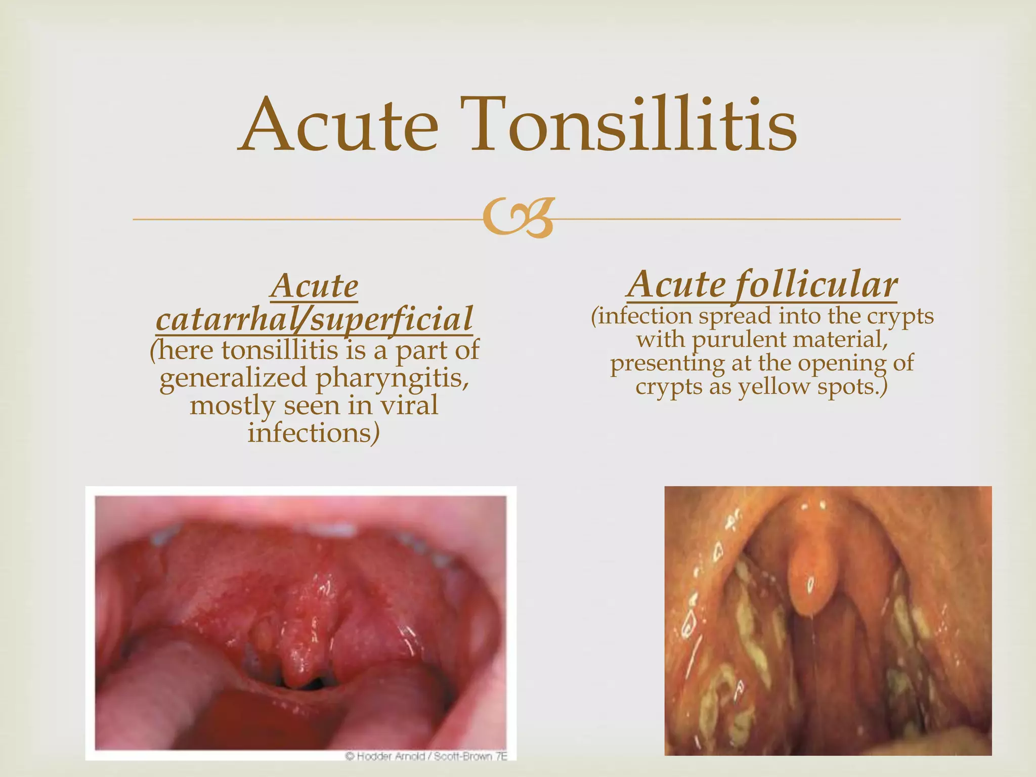 Tonsils ppt | PPTX | Ear, Nose and Throat Conditions | Diseases and ...