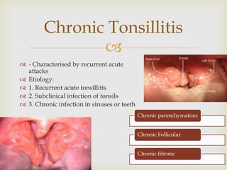 Tonsils ppt | PPTX