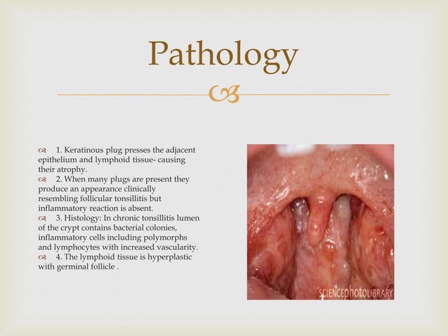 Tonsils ppt | PPTX | Ear, Nose and Throat Conditions | Diseases and ...