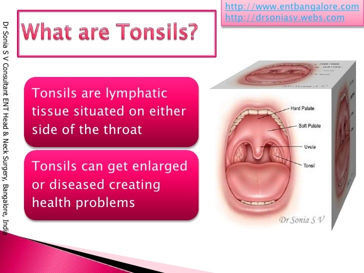 Tonsillitis-ENT Doctor Bangalore