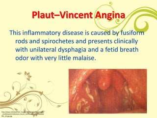 Tonsilītu diferenciāldiagnoze | PPTX | Ear, Nose and Throat Conditions ...