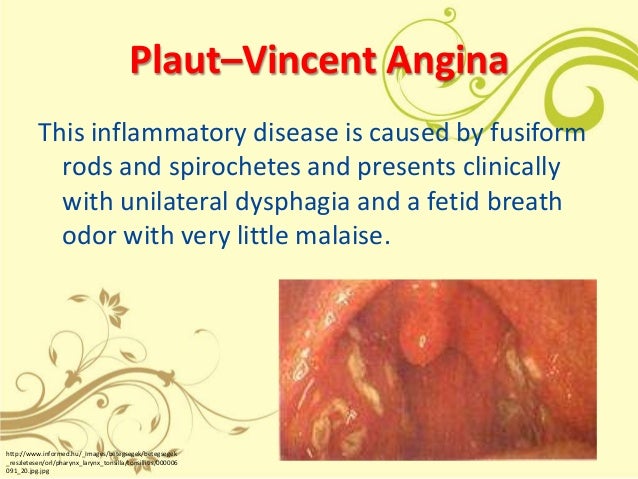Tonsilītu diferenciāldiagnoze