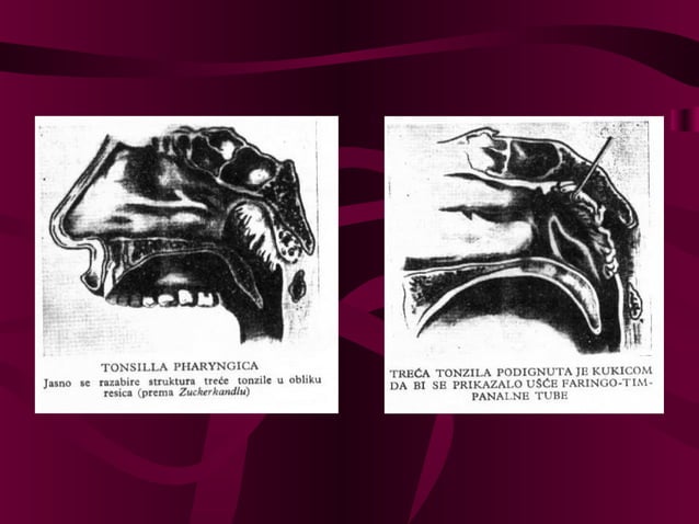 Tonsillectomy and Adenoidectomy: Post Operative Care | PPT