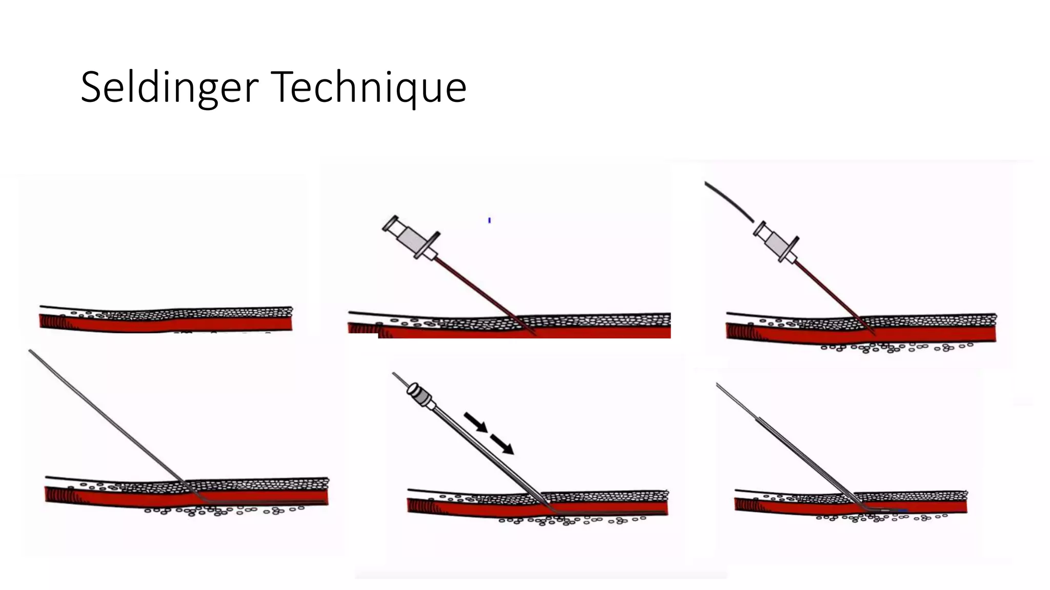 Tools in interventional radiology | PPTX
