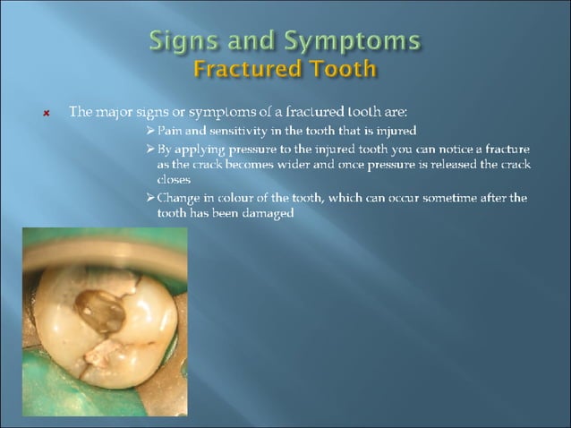 Tooth Injuries | PPT
