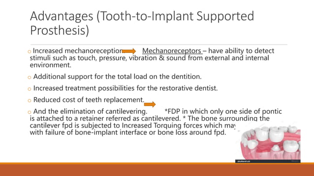 Tooth-to-Implant Supported Fixed Partial Dentures- A Comprehensive ...