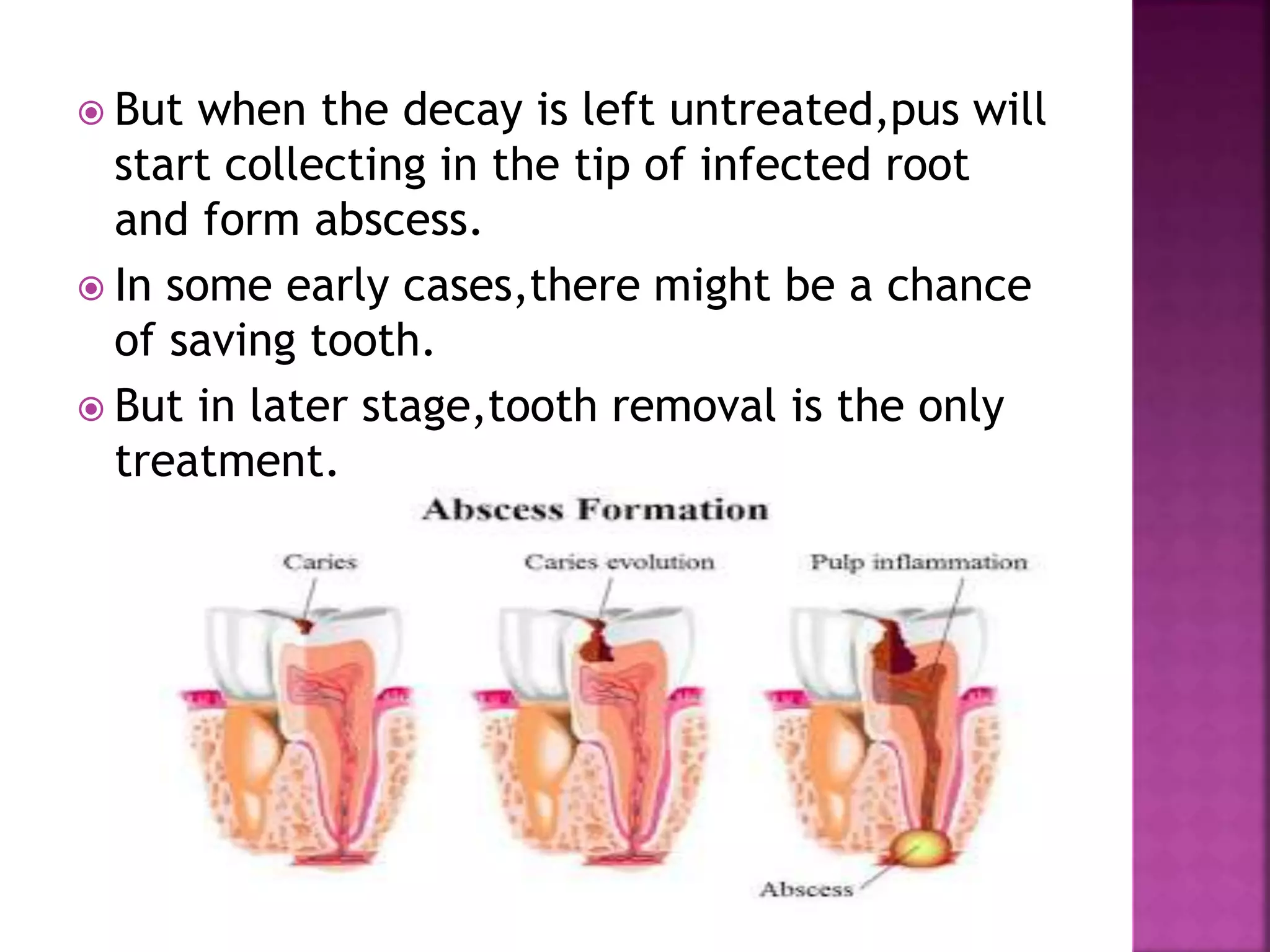 Tooth abscess | PPTX