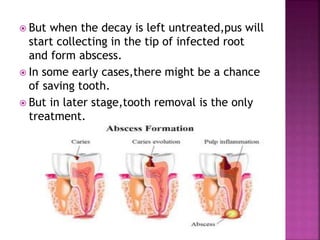 Tooth abscess | PPTX | Dental Health | Diseases and Conditions