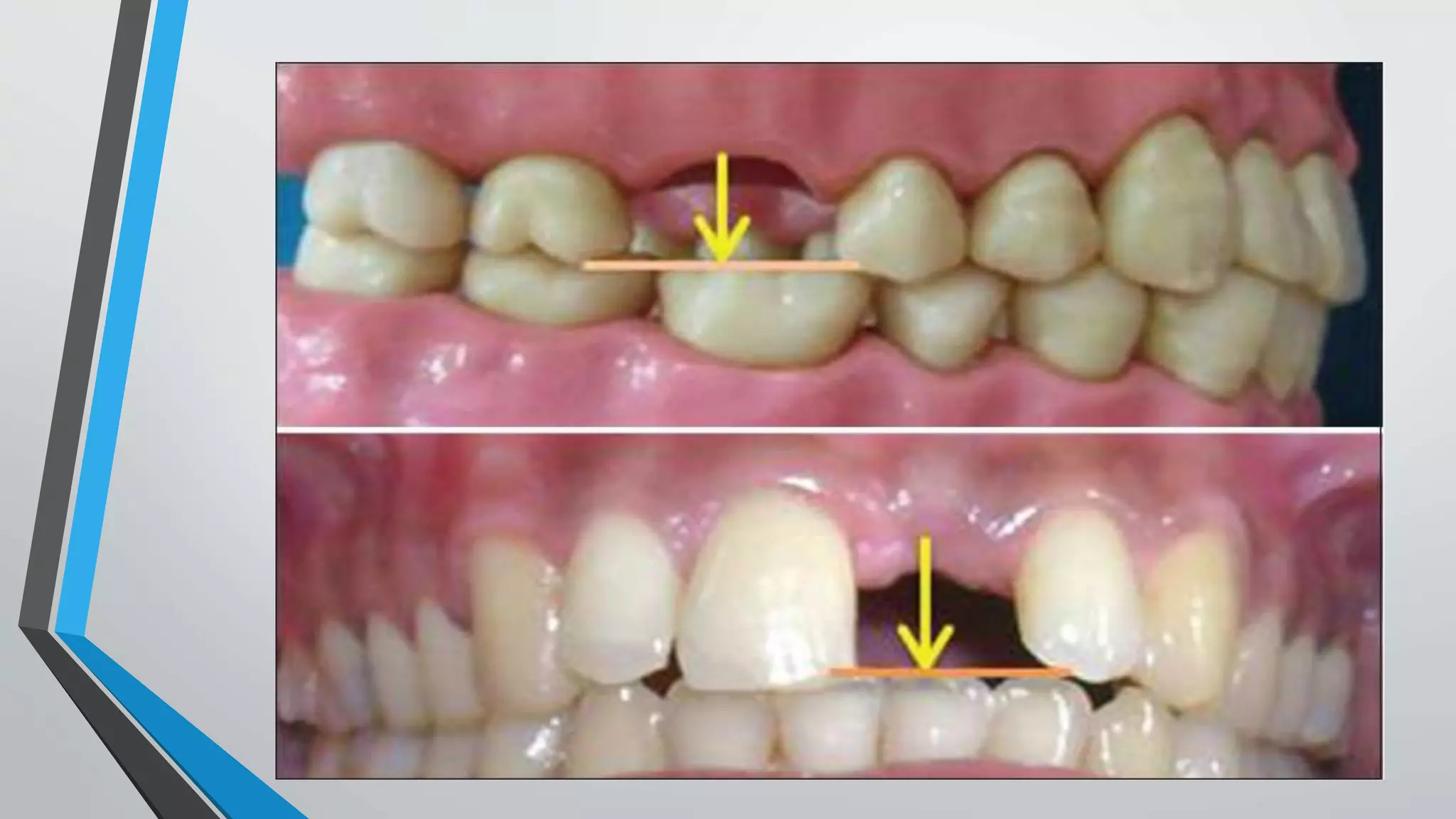 Tooth attrition | PPTX