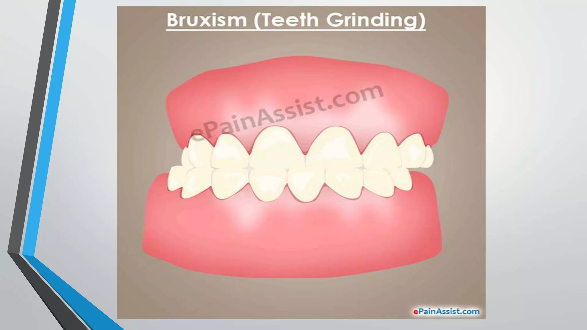 Tooth attrition | PPTX