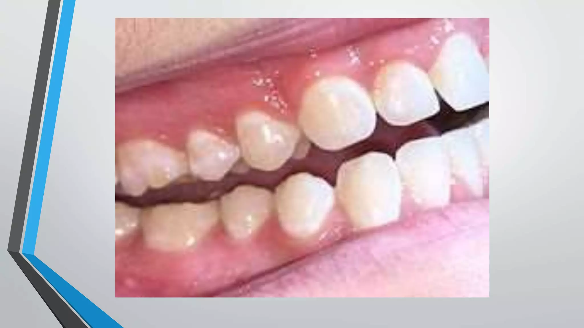 Tooth attrition | PPTX