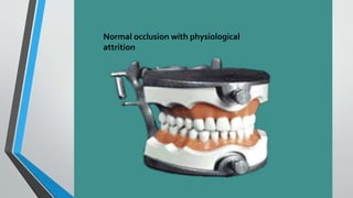 Tooth attrition | PPTX