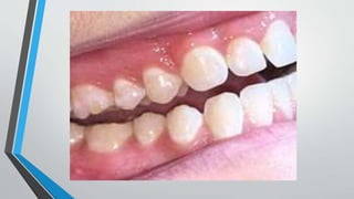 Tooth attrition | PPTX