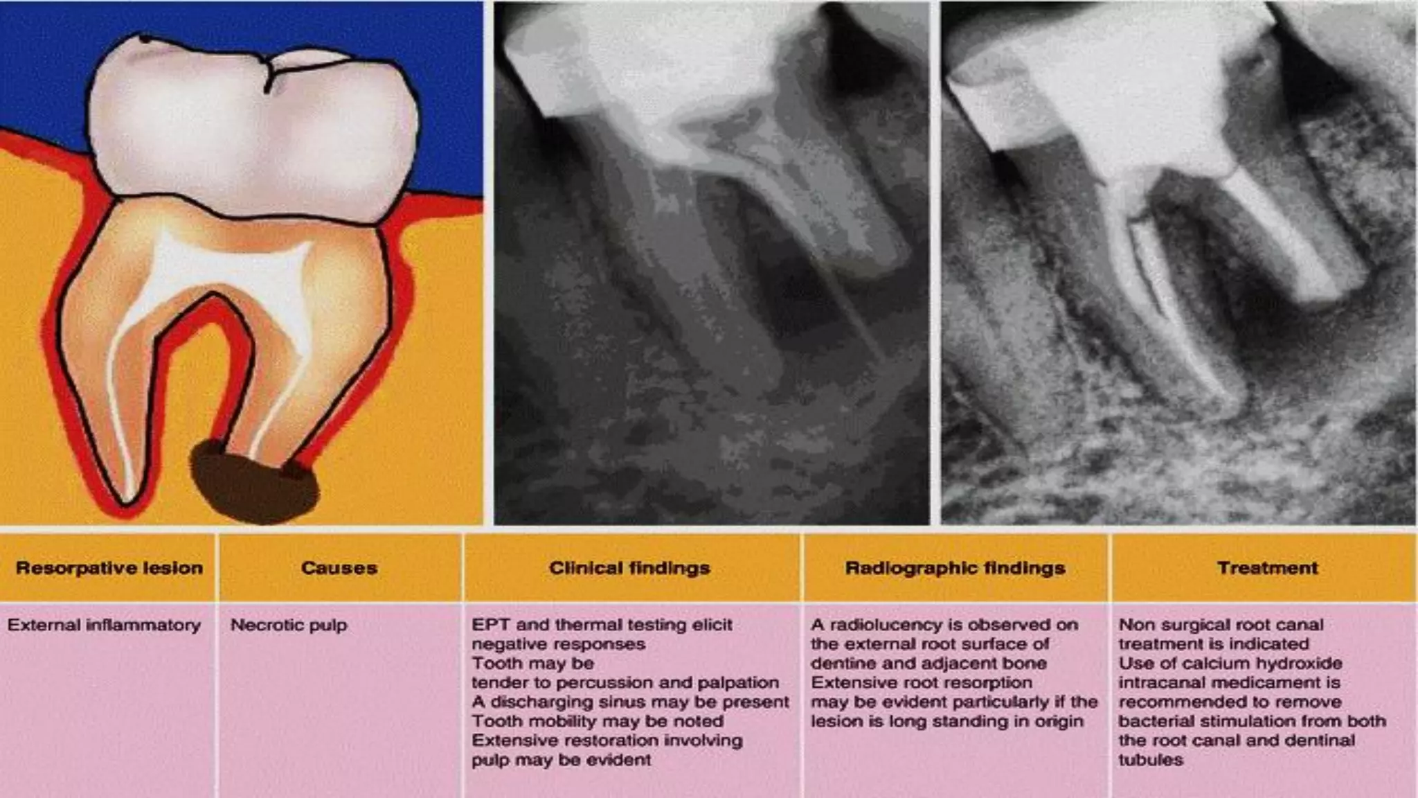 tooth avulsion.pdf